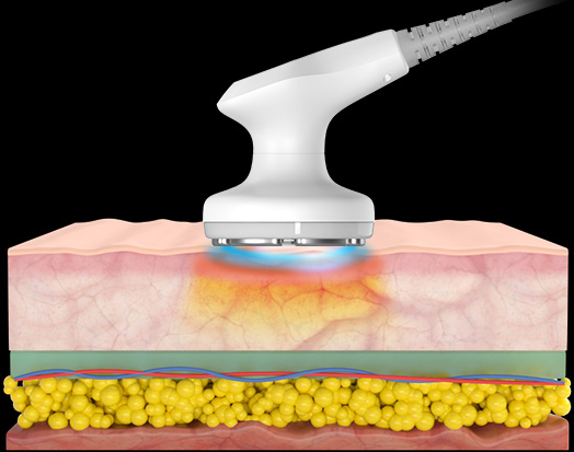 RF Slimming Treatment Singapore | V Aesthetics Body Slim